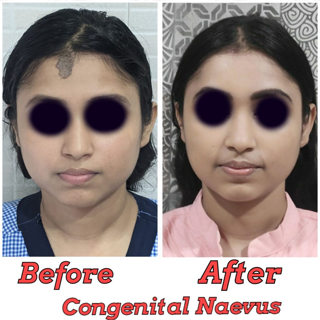Birthmarks-Congenital Lesions Over Face - drpreetishbhavsar